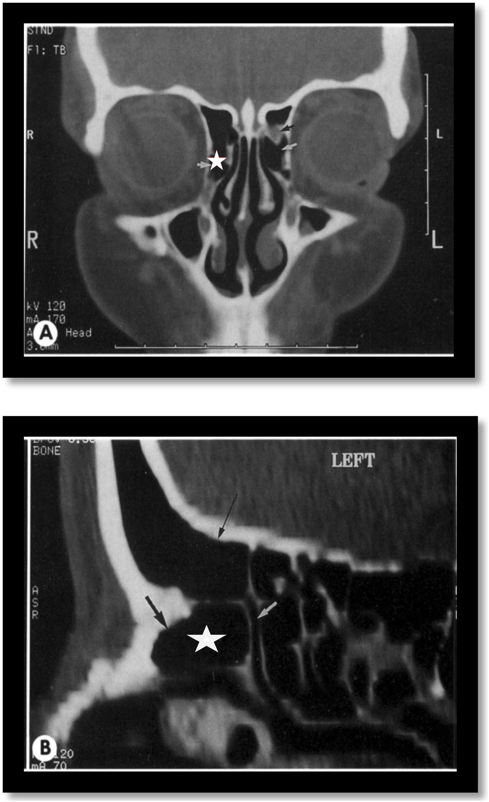 Analysis of the frontal recess pneumatization pattern in patients with ...