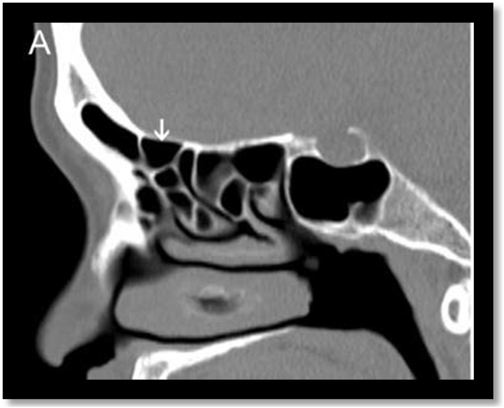 Analysis of the frontal recess pneumatization pattern in patients with ...