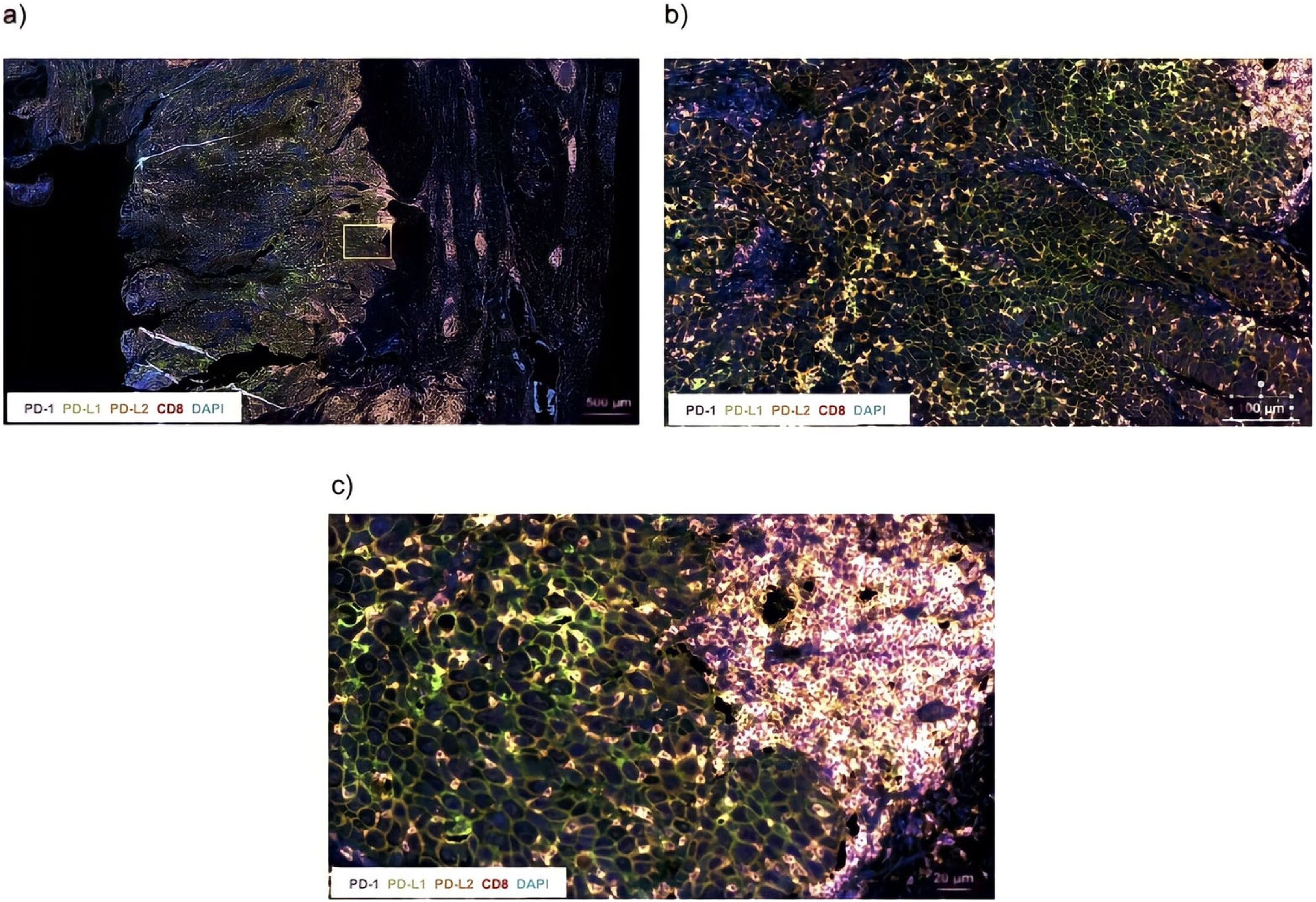 Can the co-localization of CD8+, PD-1, PD-L1 AND PD-L2 patterns provide ...