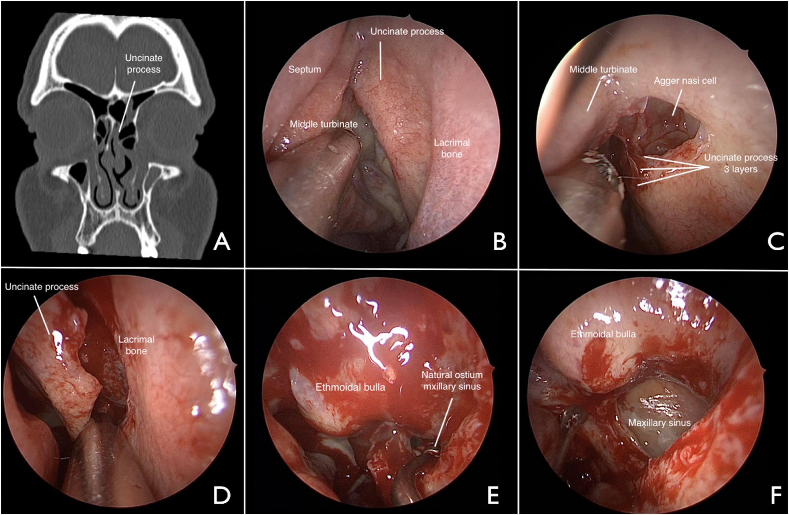 uncinate process sinus