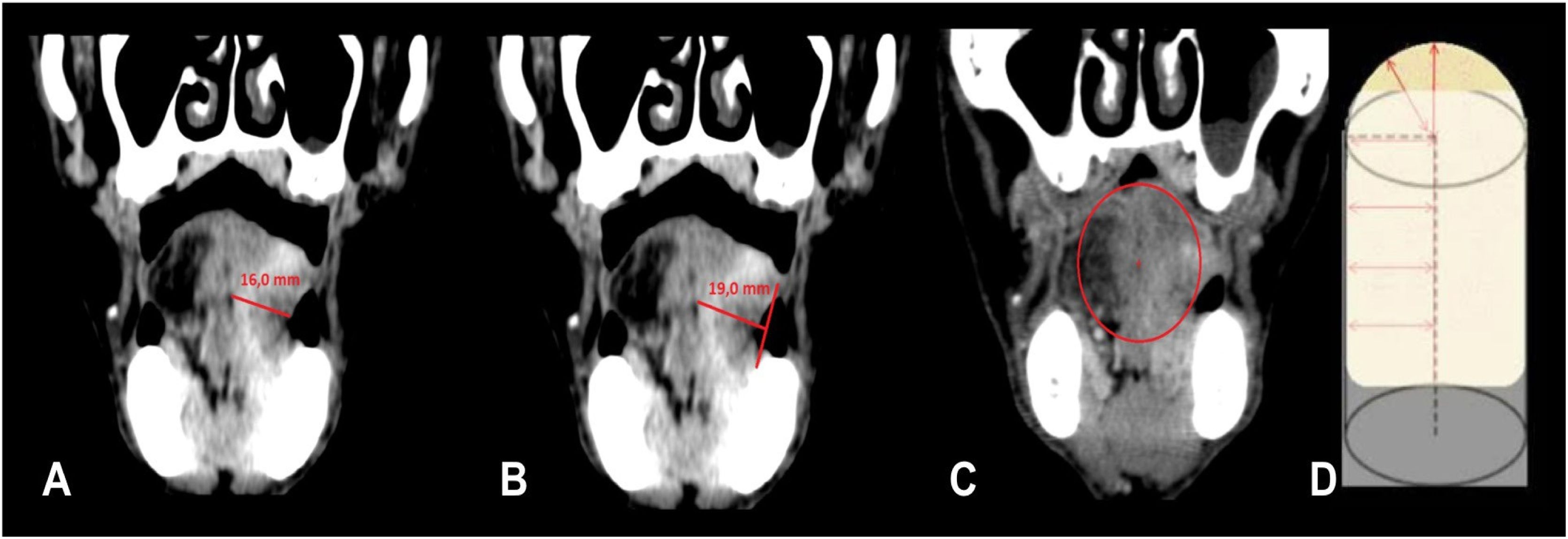 Staging of oral cavity cancer in the 8th edition of the TNM ...