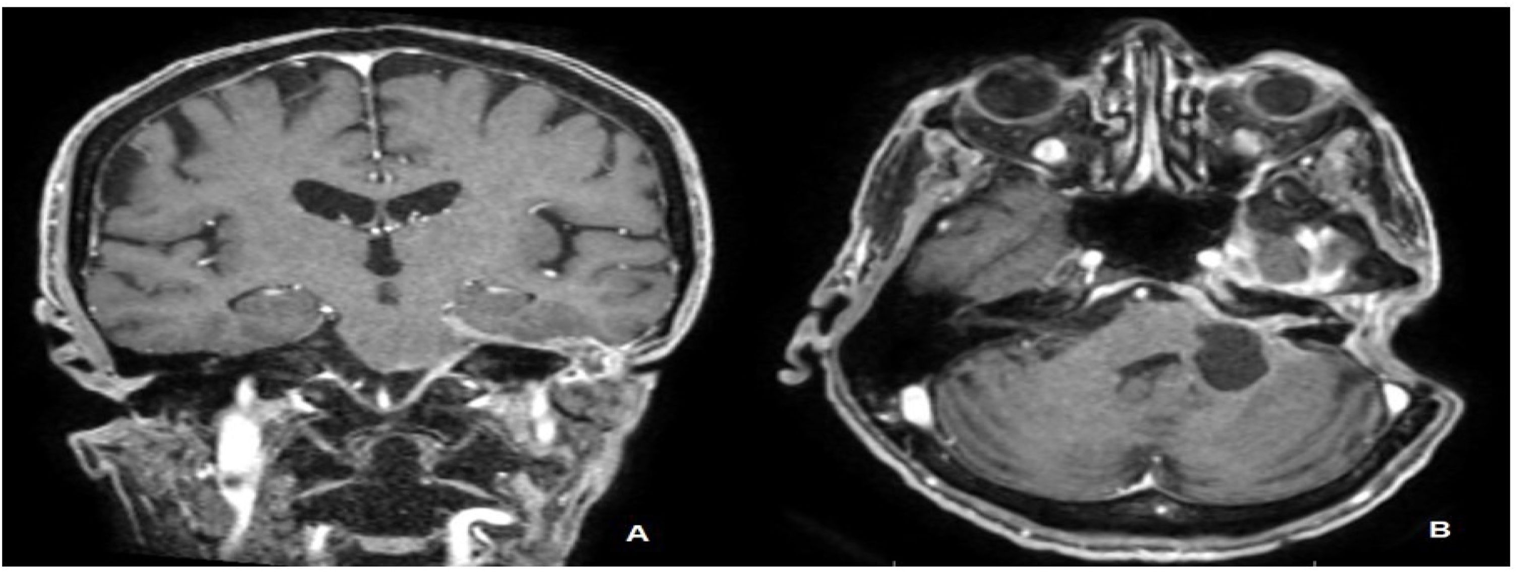Metastatic basal cell carcinoma: Case series and literature review ...