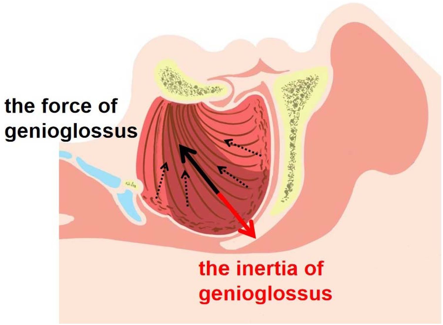 Analysis on the plane and mechanism of tongue-originated obstruction in ...