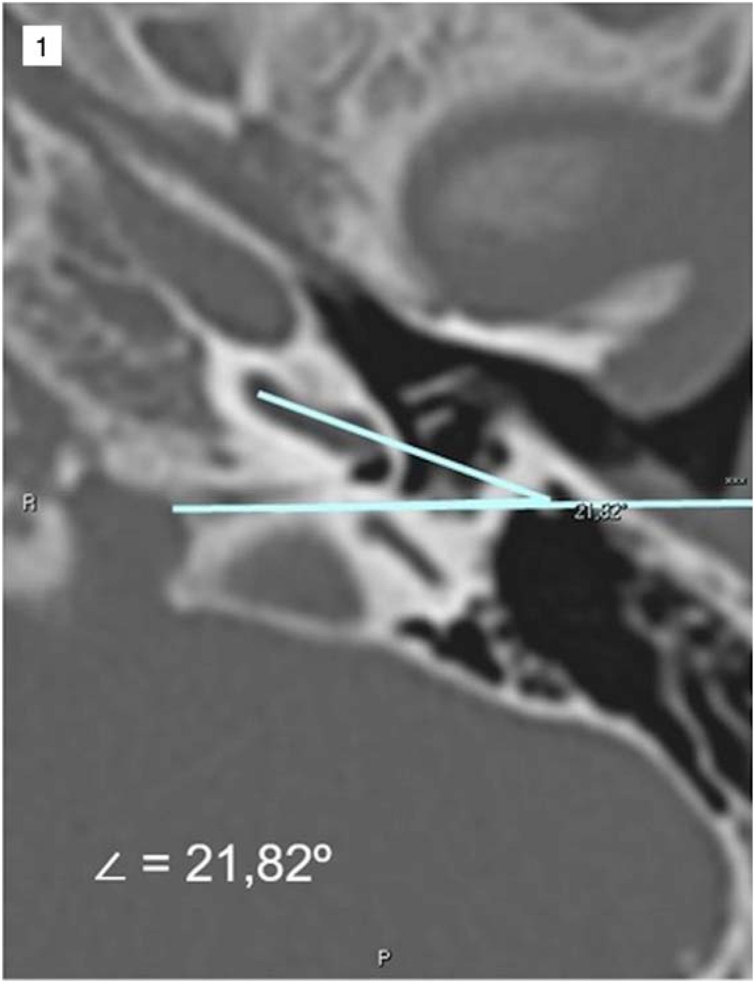 Tomographic comparison of the cochlea, oval window, round window and ...