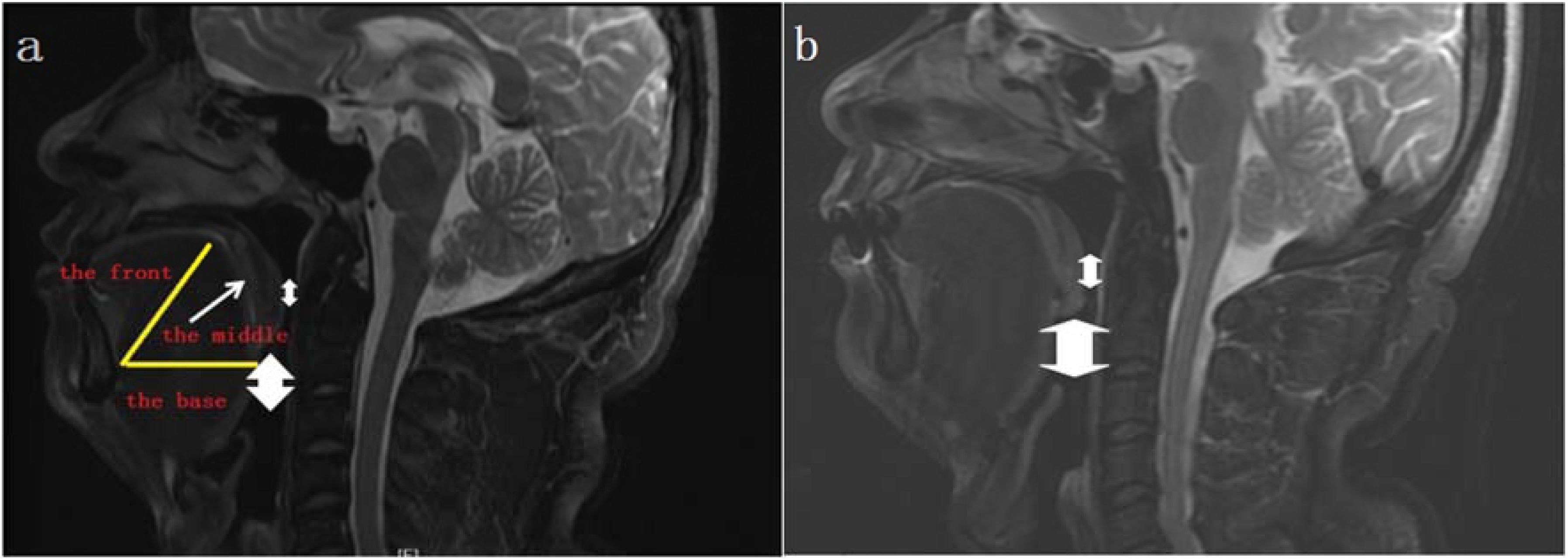 Analysis on the plane and mechanism of tongue-originated obstruction in ...