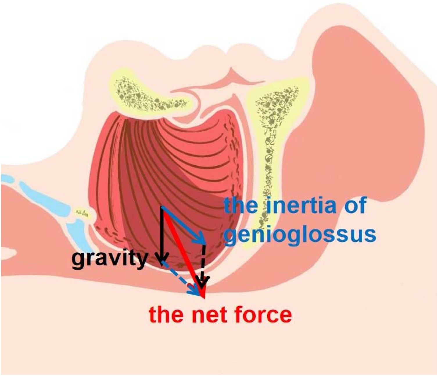 Analysis on the plane and mechanism of tongue-originated obstruction in ...