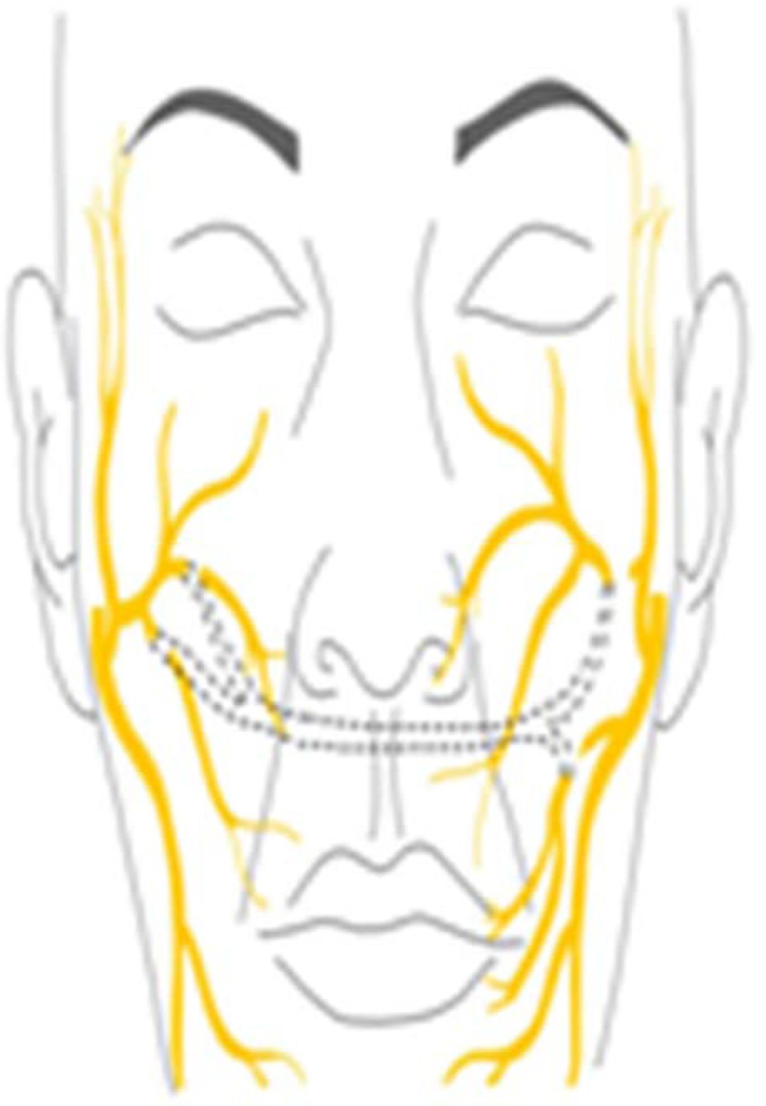 Simultaneous intraparotid and intratemporal facial nerve schwannoma ...
