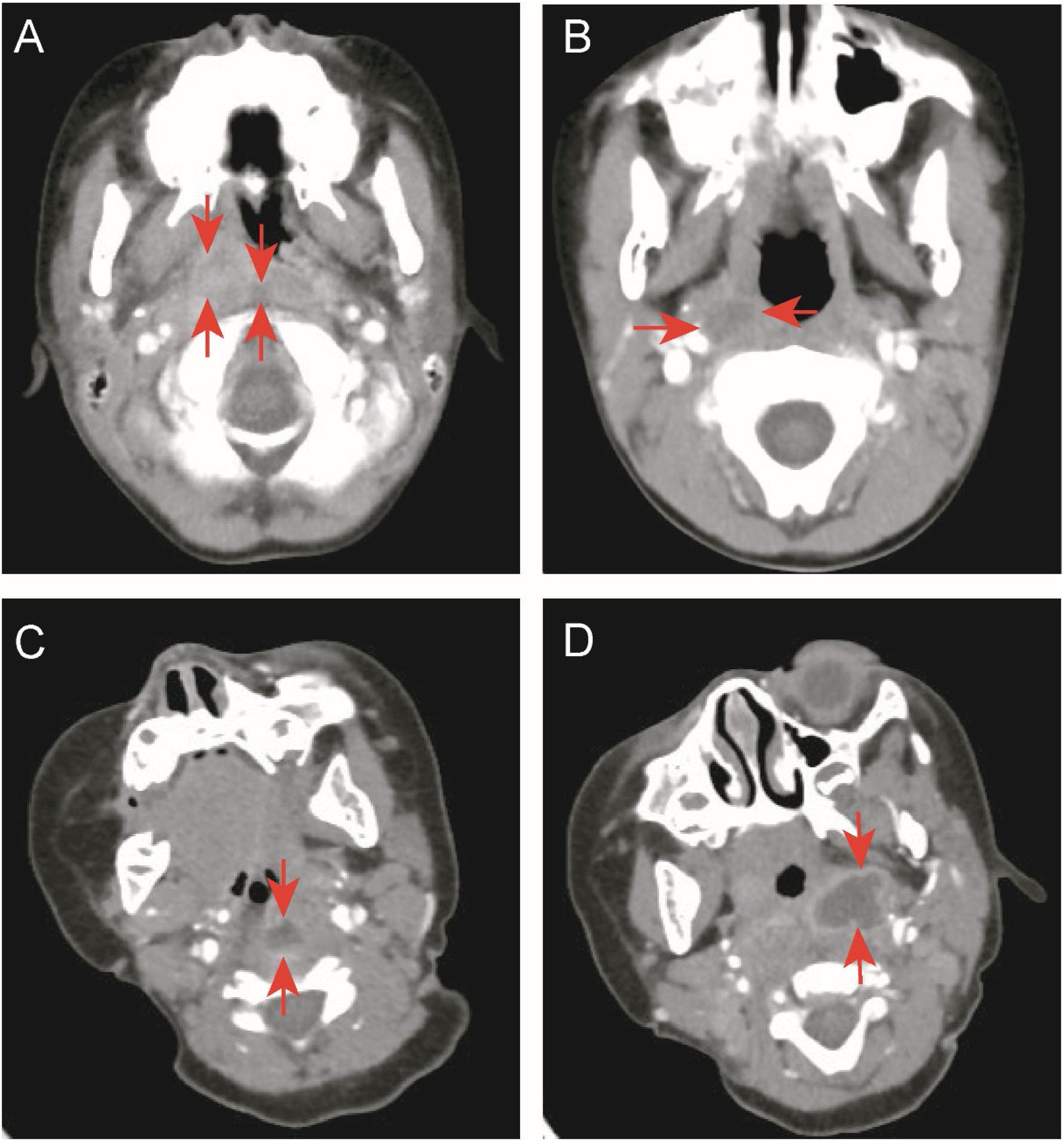 Parapharyngeal and retropharyngeal infections in children: Kawasaki ...