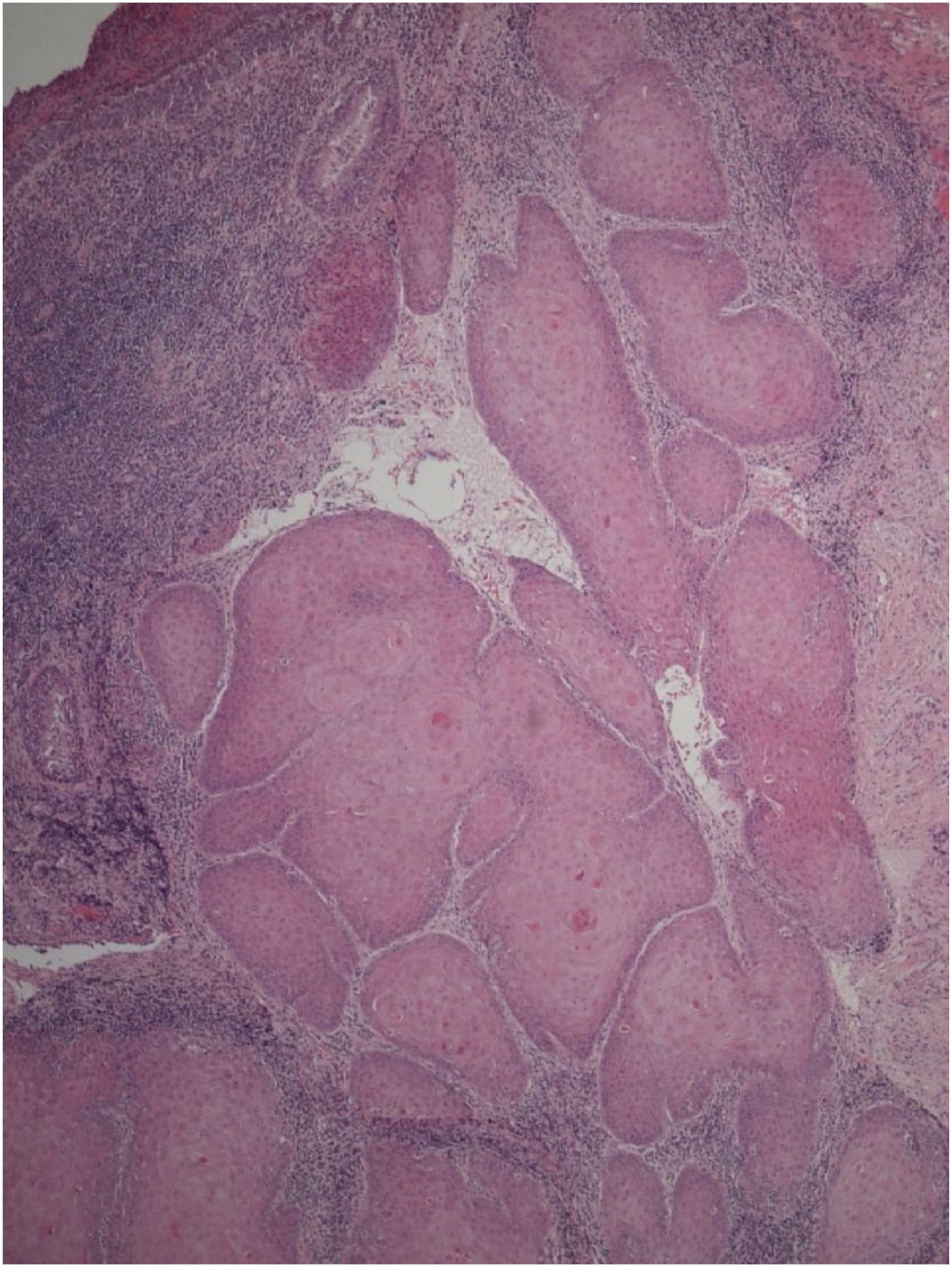 Squamous Cell Carcinoma Arising From A Cholesteatoma Of The Maxillary