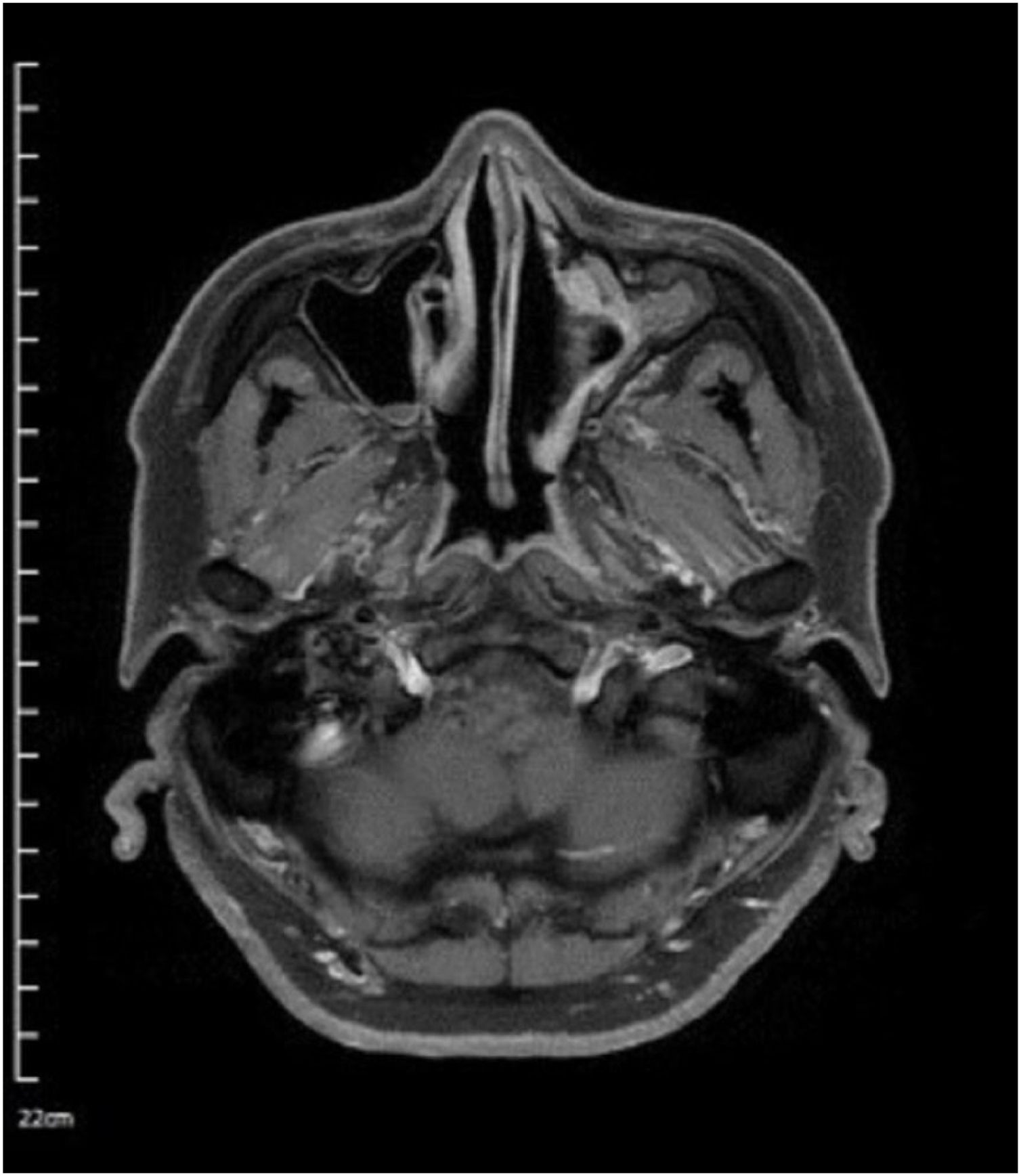 Squamous cell carcinoma arising from a cholesteatoma of the maxillary ...