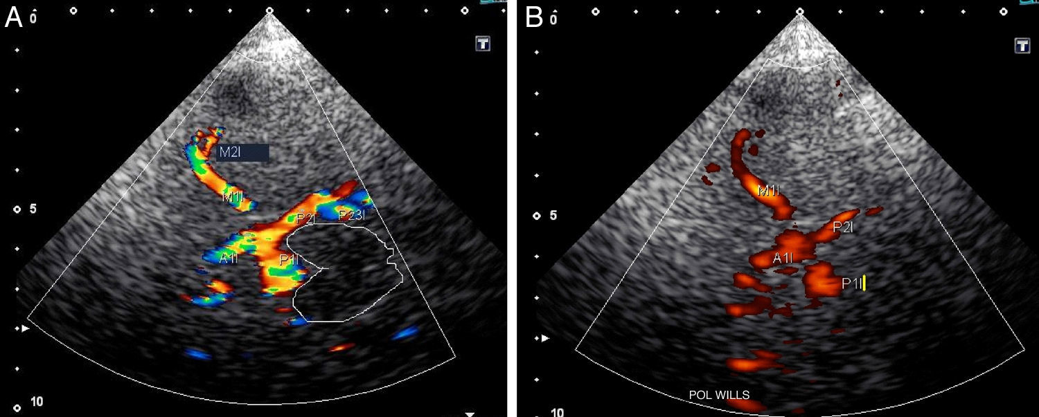 El eco-doppler color transcraneal en el estudio vascular cerebral ...