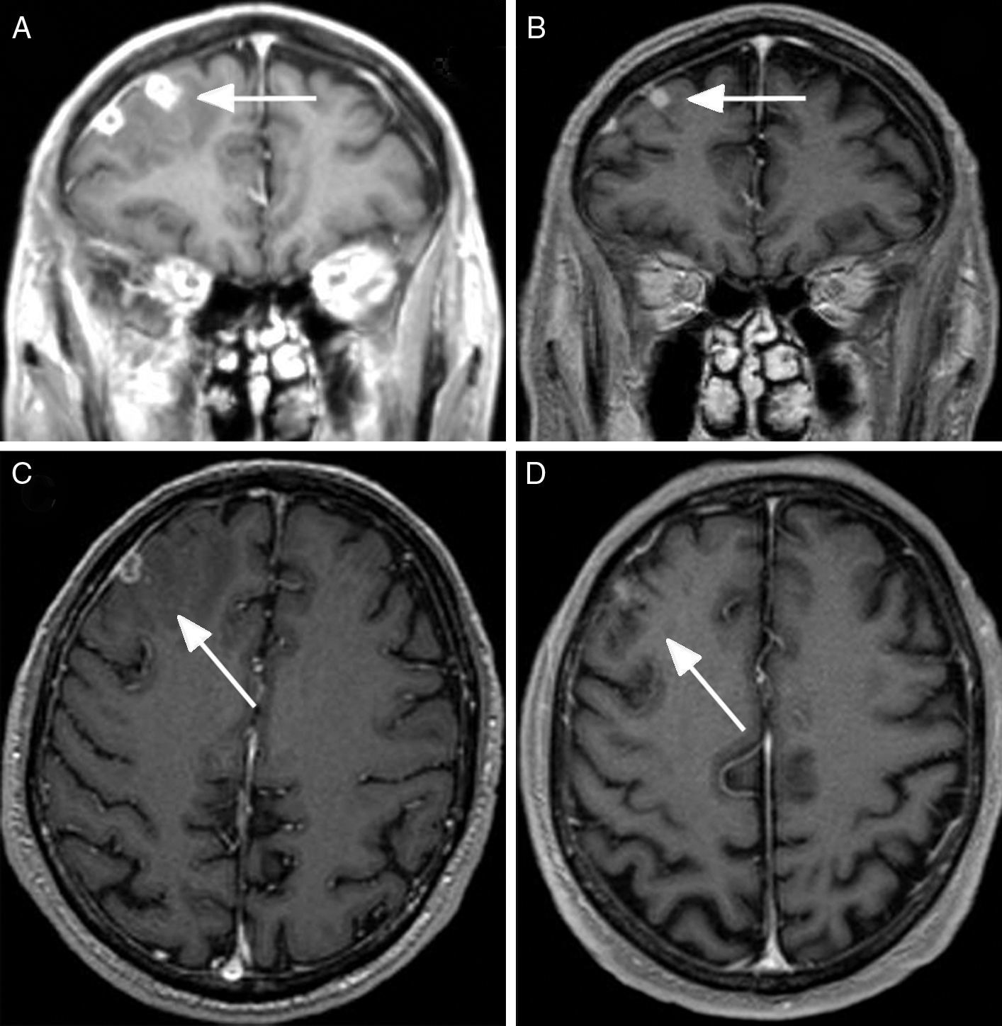 Tuberculoma cerebral en placa. Presentación atípica de tuberculosis en ...