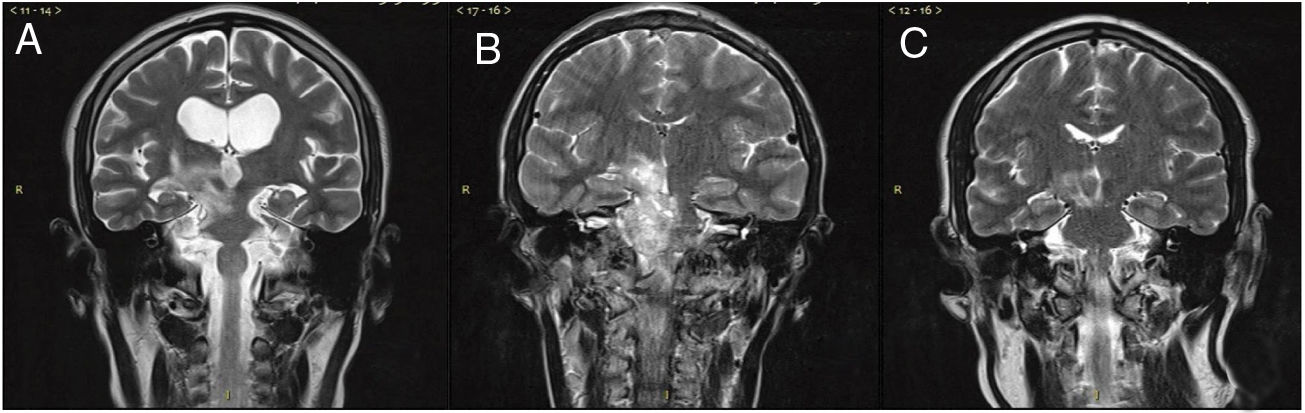 Neurobehcet: signo de la cascada | Neurología Argentina