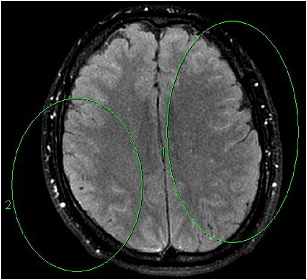 Romboencefalitis asociada a anticuerpos anti-receptor de NMDA: una ...
