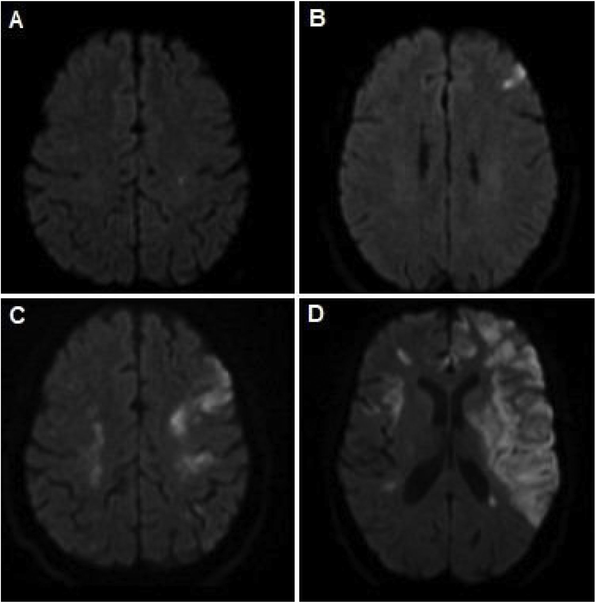 Síndrome de Cogan asociado a vasculitis sistémica con evolución tórpida ...
