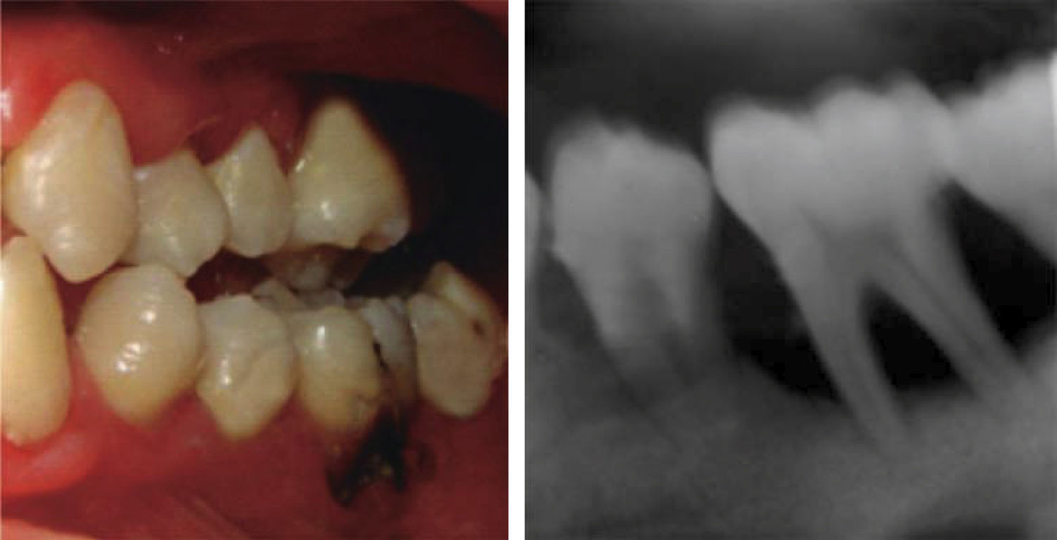 Cyclic neutropenia. Clinical case report | Revista Odontológica Mexicana