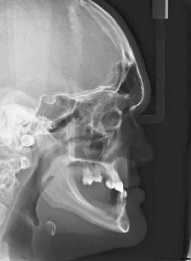 ectodermal dysplasia teeth xray
