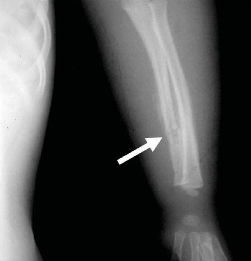 Battered child syndrome with stomatological repercussions. Case report ...