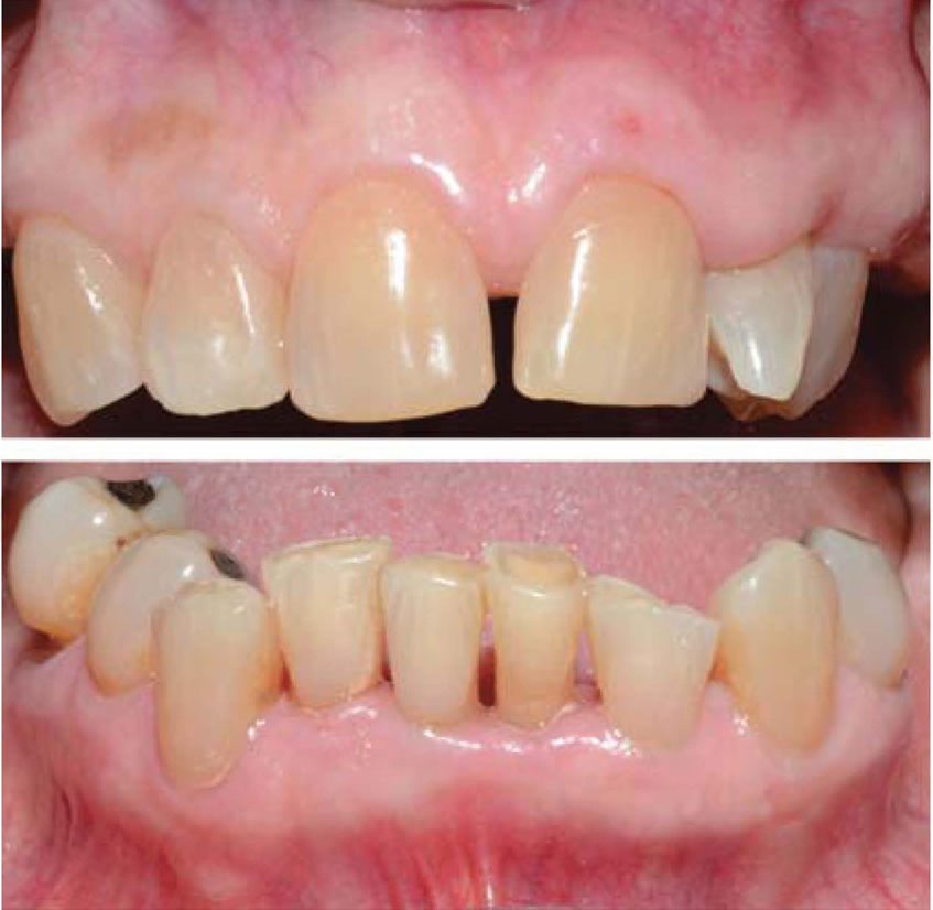 fibrotic gingivitis