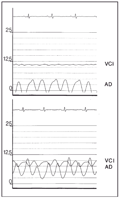 Intraluminal dilation of inferior vena cava stenosis after repair of ...