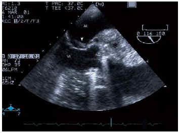 Highly aggressive early prosthetic endocarditis by S. epidermis ...