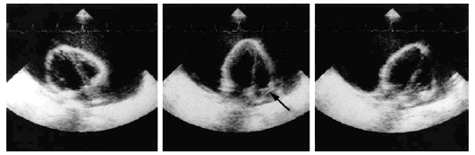 Swinging Heart | Revista Española de Cardiología