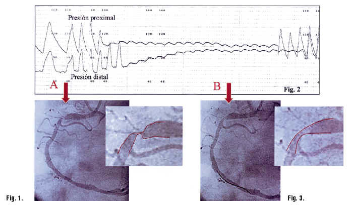 Findings with a Pressure Guide Wire in Acute Coronary Syndrome
