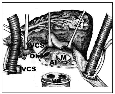 Left Atrial Reduction. A New Concept in Surgery for Chronic Atrial ...
