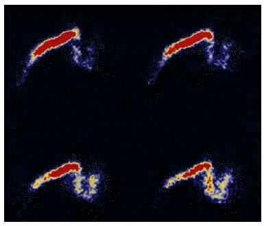Pitfalls in Left Atrial Reduction. Superior Neo-Cava with Pericardium ...