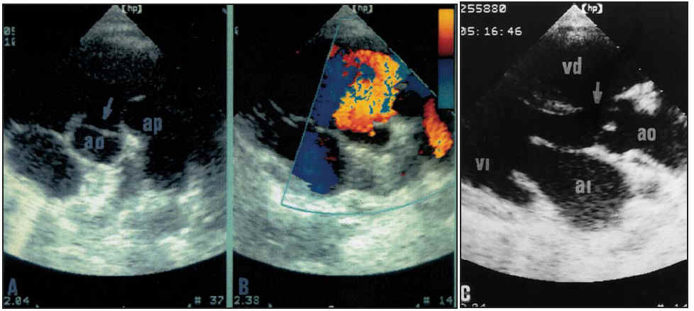 Aortic Valve Complications Associated with Subarterial Infundibular ...