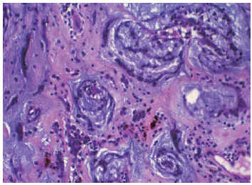 Right Atrial Myxoma in a Patient with Antiphospholipid Antibodies ...