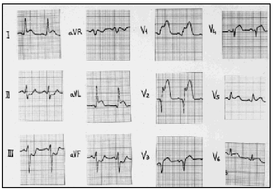 Usefulness of the Electrocardiogram in Predicting the Occlusion Site in ...