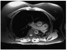Extreme Levocardia | Revista Española de Cardiología