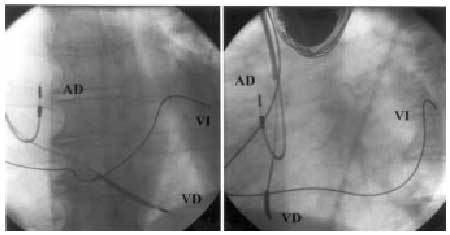 Biventricular Pacing as a Treatment for Advanced Heart Failure ...