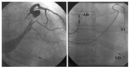 Biventricular Pacing as a Treatment for Advanced Heart Failure ...