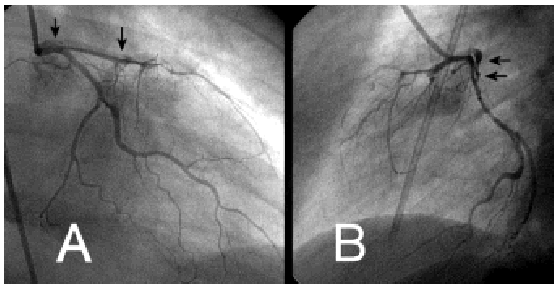 Spontaneous Dissection of the Left Main Coronary Artery Treated by ...