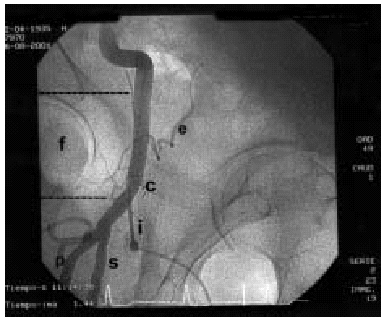 Complications with Femoral Access in Cardiac Cathetization. Impact of ...
