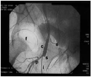 Complications with Femoral Access in Cardiac Cathetization. Impact of ...