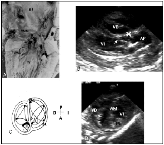 Left Ventricular Outflow Tract Obstruction in Transposition of the ...