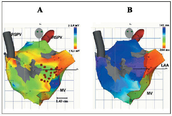 Non-Fluoroscopic Electroanatomical Mapping (CARTO System) in the ...