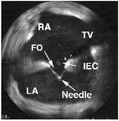 Learning Process for Transseptal Puncture Guided by Intracardiac ...