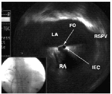 Learning Process for Transseptal Puncture Guided by Intracardiac ...