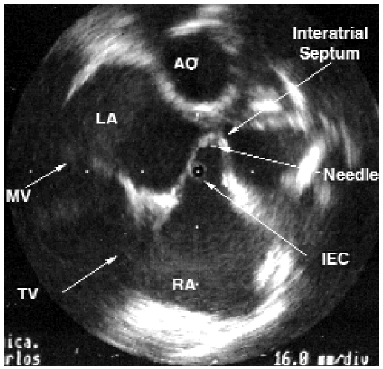 Learning Process for Transseptal Puncture Guided by Intracardiac ...