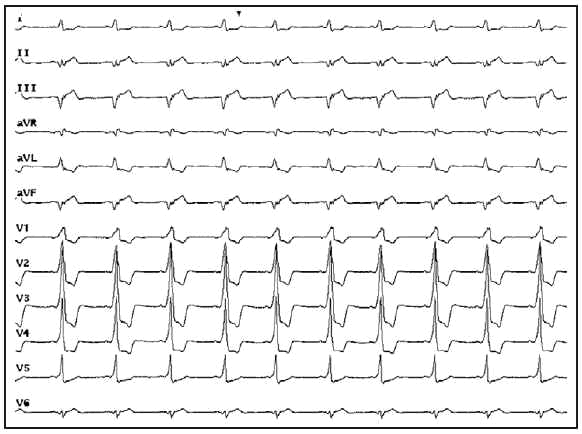 Intermittent Atrioventricular Block in an Accessory Pathway Associated ...