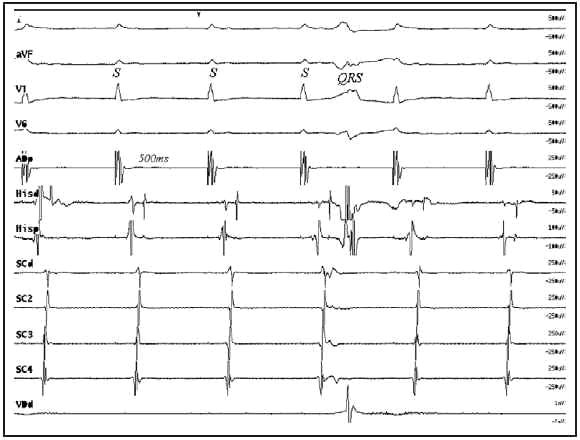 Intermittent Atrioventricular Block in an Accessory Pathway Associated ...