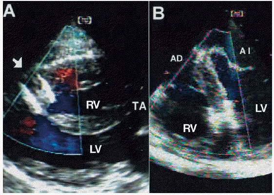 Percutaneous Closure of Ventricular Septal Defect With an Amplatzer ...
