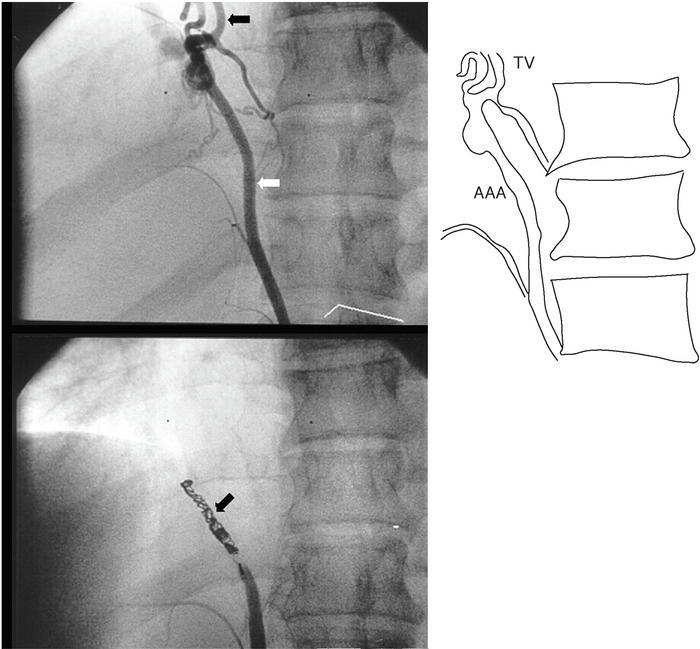Percutaneous Closure of Complex Fistula Between the Internal Mammary ...