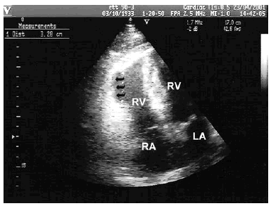 Right Ventricular Dysfunction and Ischemia in Pulmonary Embolism ...