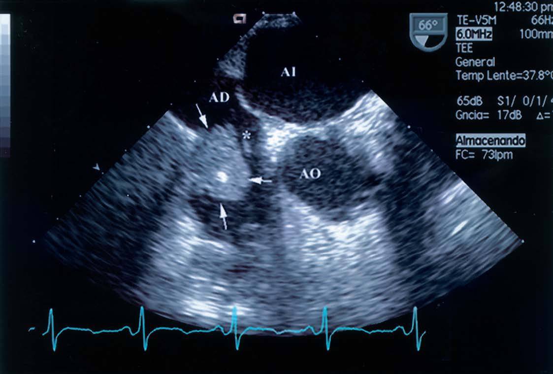 Right Atrial Thrombus Related to Venous Catheter | Revista Española de ...