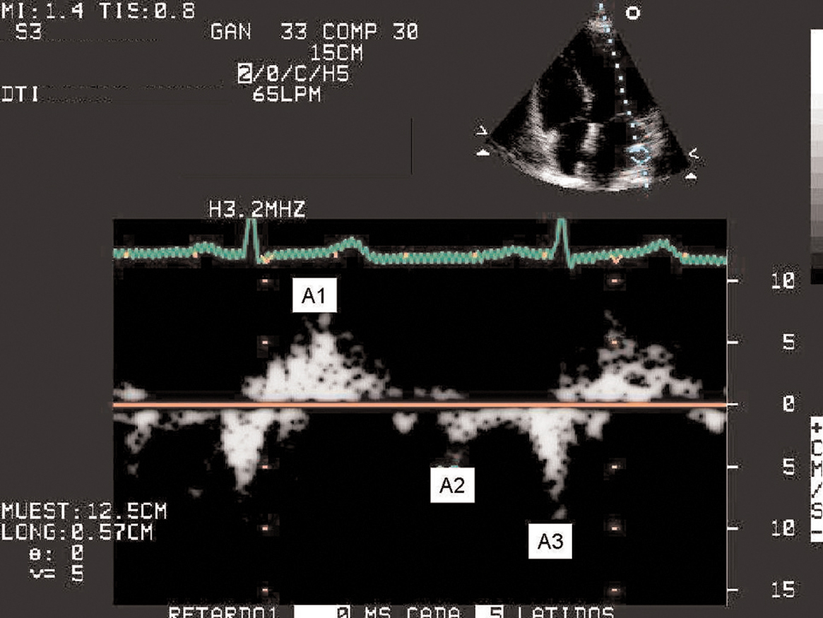 Assessment of Left Atrial Wall Velocities by Pulsed Wave Tissue Doppler ...